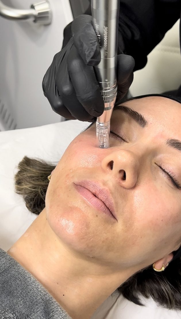 Microneedling Woking | BodyLab Aesthetics